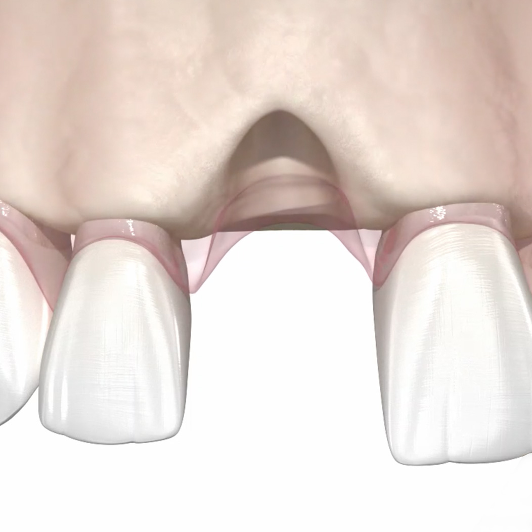 Socket Preservation Westlake Village | After Tooth Extraction