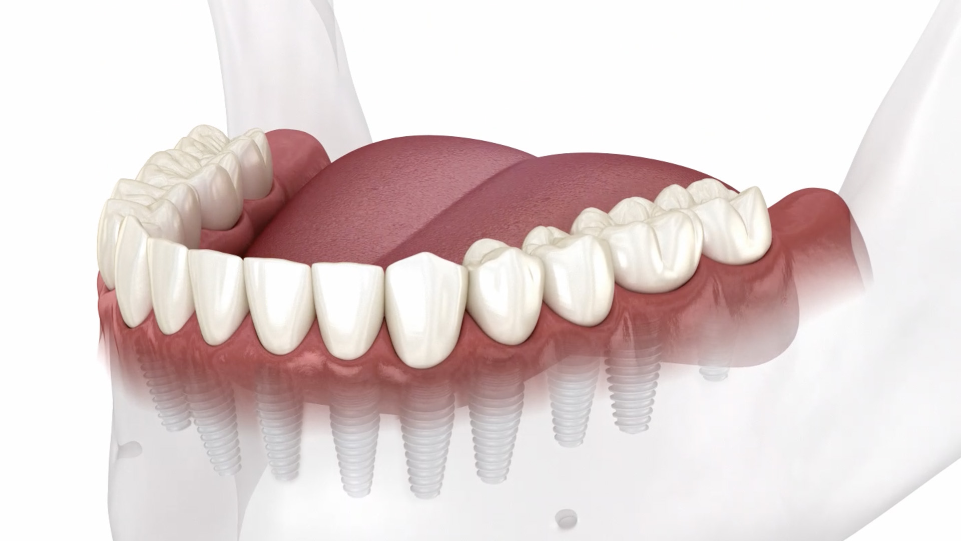 All on 4 Dental Implants Westlake Village | Full Mouth Dental Implants
